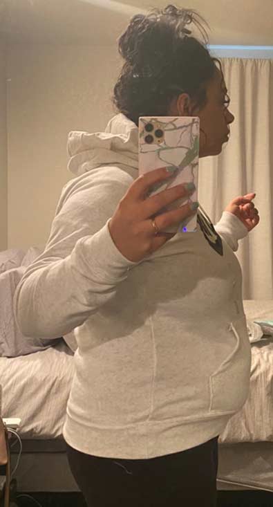 Before and After ESG procedure | Be Better Bariatrics